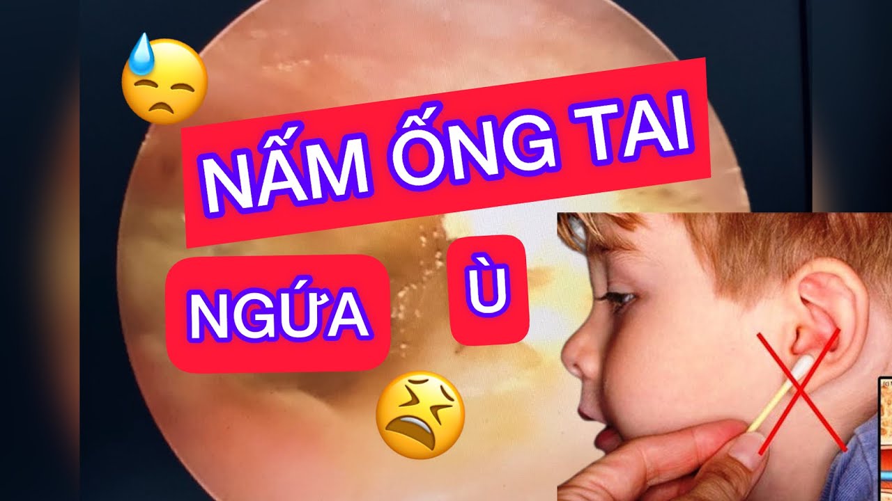 Nấm Và Dịch Mủ Trong Tai / Viêm Nấm Ống Tai Ngoài / Tai - Mũi - Họng ...