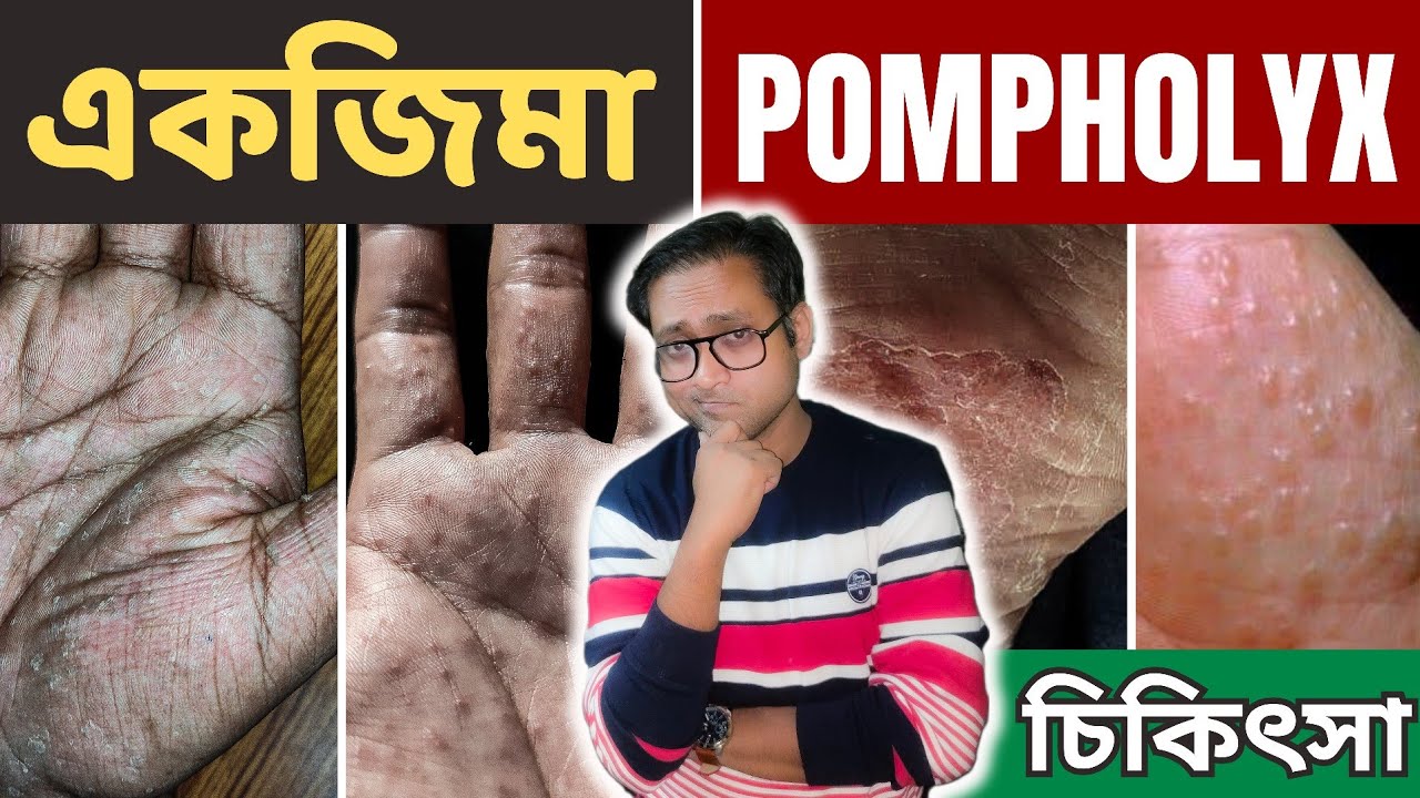 Dyshidrotic eczema | Pompholyx | চিকিৎসা | Dr Supratim Saha - YouTube