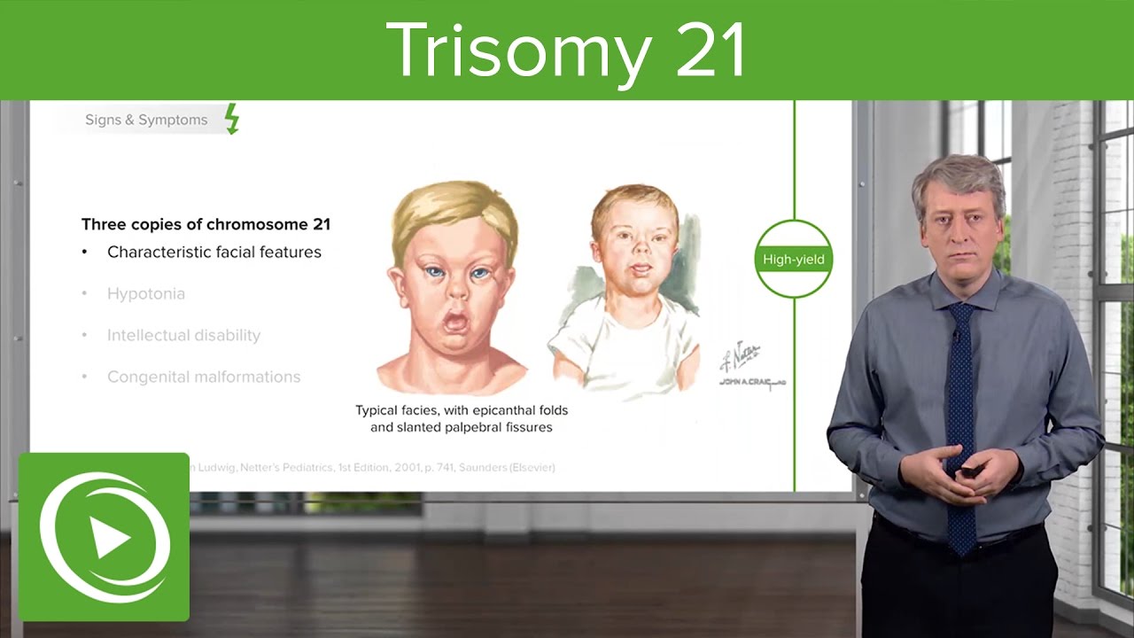 Trisomy 21 (Down Syndrome): Introduction – Pediatrics | Lecturio - YouTube