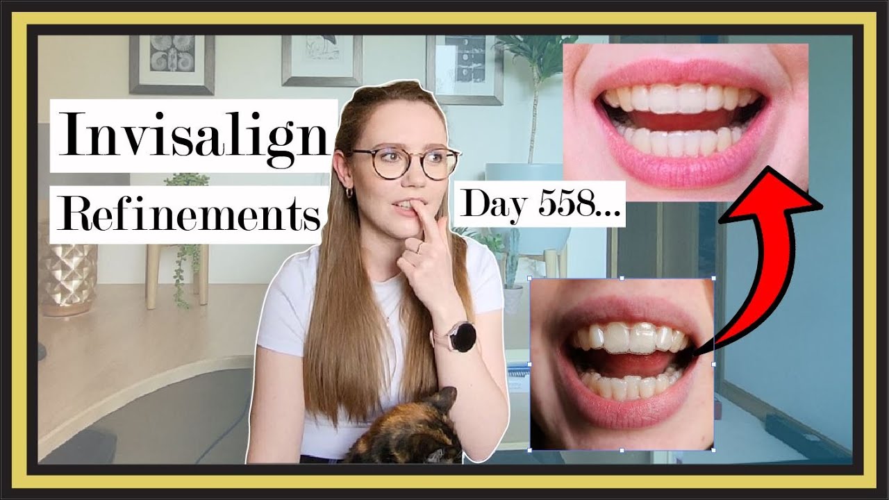 Invisalign Refinements Update (18 months later) | Cracked Tray, Stained ...