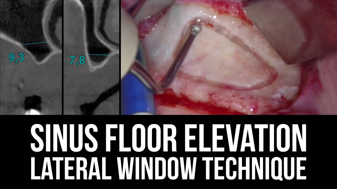 Maxillary Sinus Lift with Lateral Window Technique - YouTube