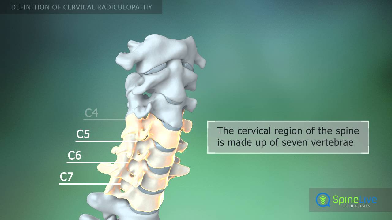 Cervical radiculopathy. Definition - YouTube
