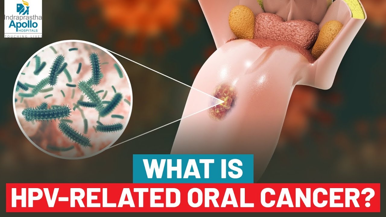 What Is HPV-Related Oral Cancer? | Oropharyngeal Cancer | Dr. Anil D'Cruz | Apollo Hospital ...