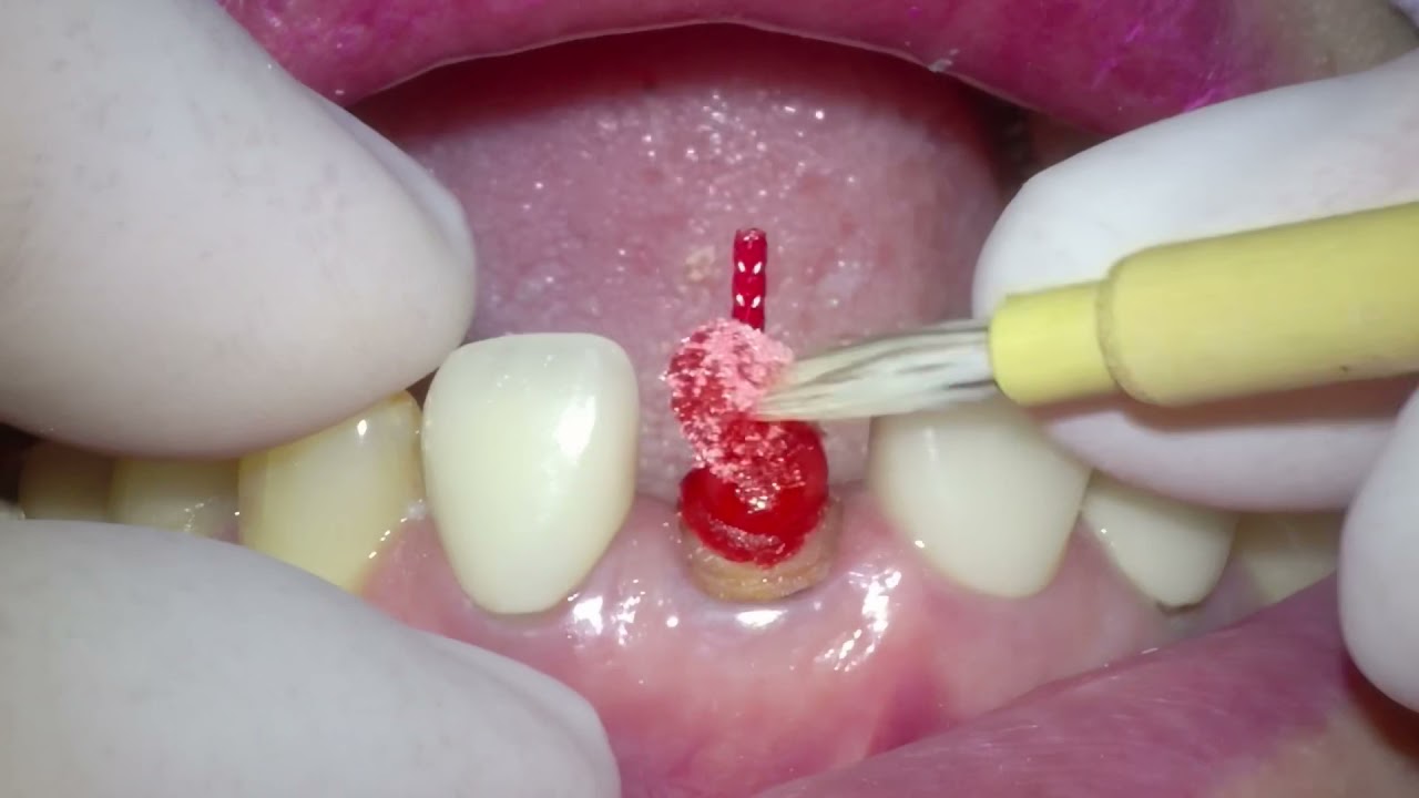 #21 metal casting post, direct post and core pattern fabrication ...