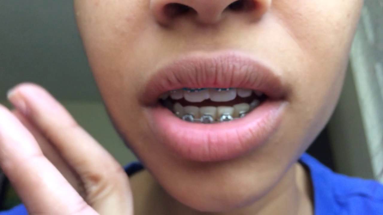 Major Braces Update | Power Chain - YouTube