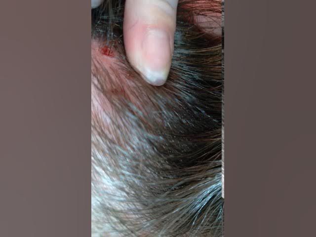 Scalp Scabs Picking
