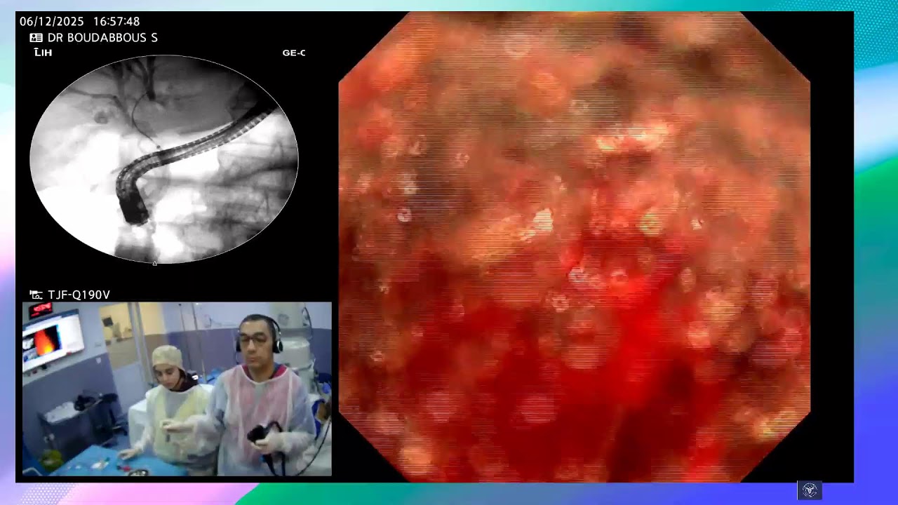 ERCP for ACUTE CHOLANGITIS in alterd anatomy - YouTube