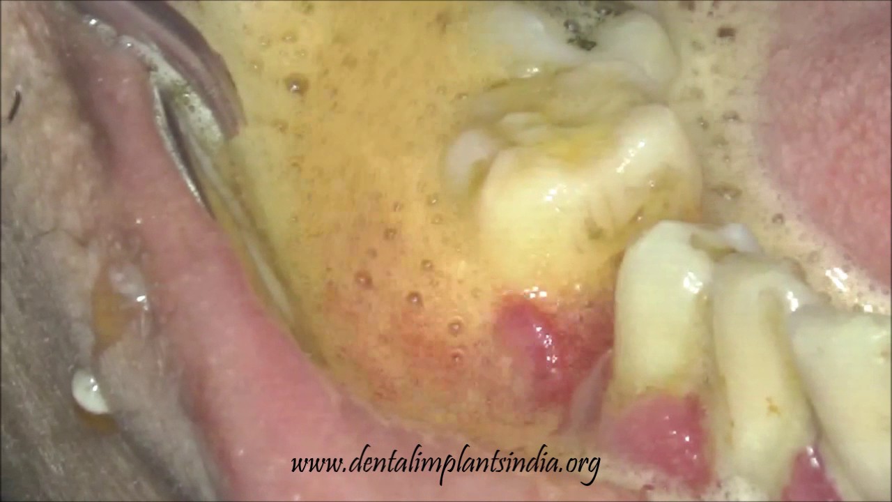 extraction of periodontal abscessed lower premolar & implant placement ...