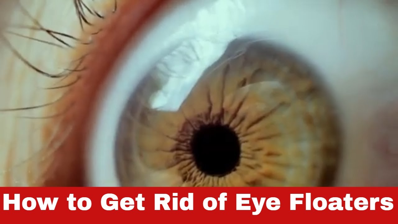 Get Your Clear Vision Back: How to Get Rid of Eye Floaters. - YouTube