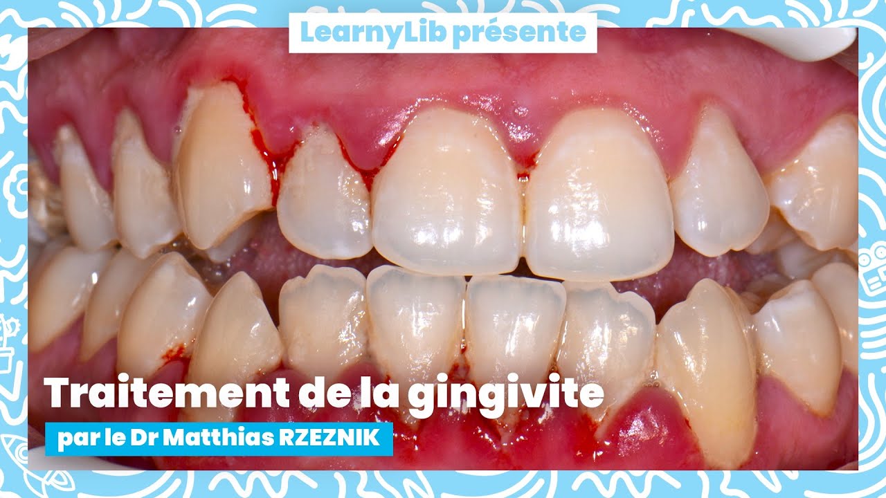 🦷 La parodontie : traitement de la gingivite avec le Dr Matthias ...