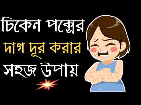 পক্সের দাগ দূর করার 100% কার্যকারী উপায় | Chicken Pox Removal Treatment | (NEW)