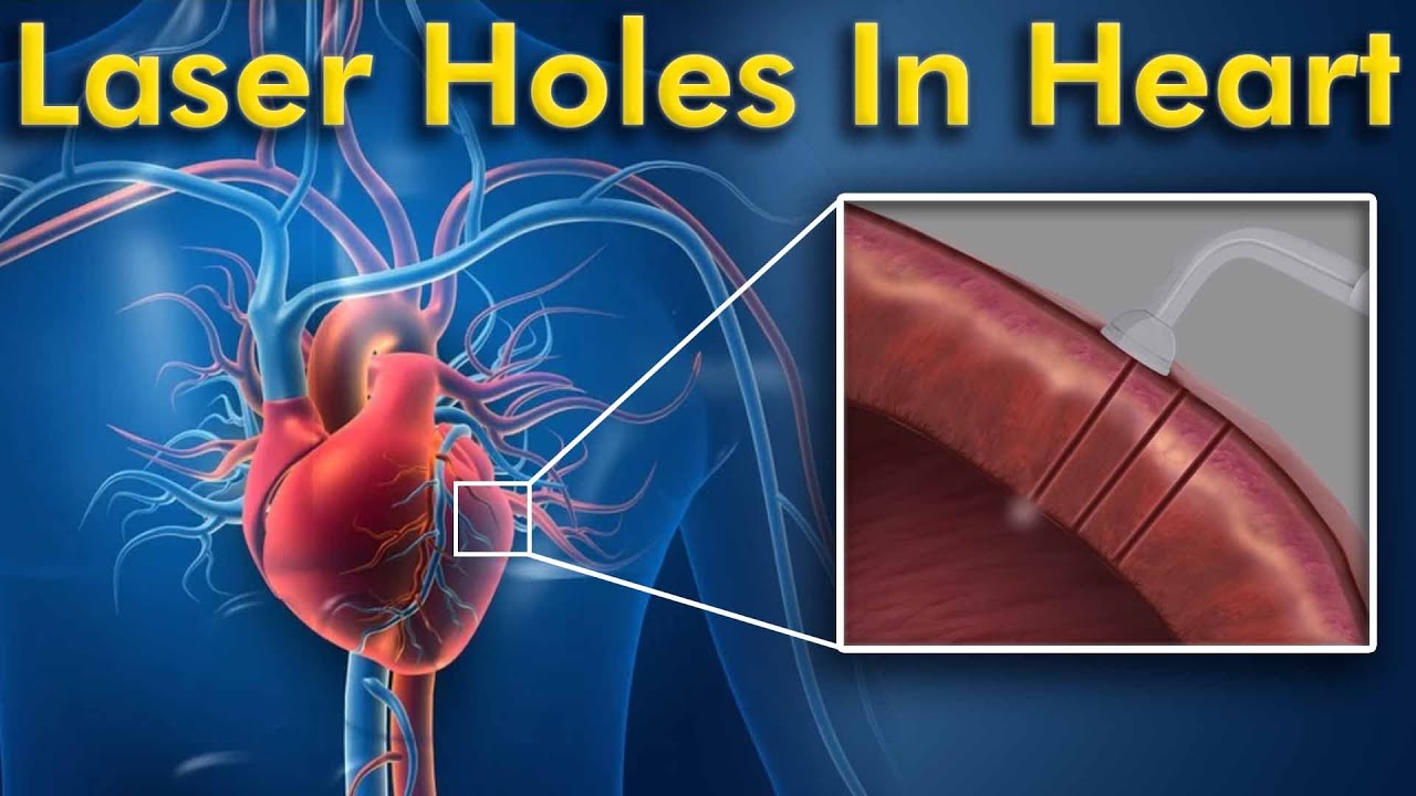 Transmyocardial Revascularization: Angina or Coronary artery treatment ...