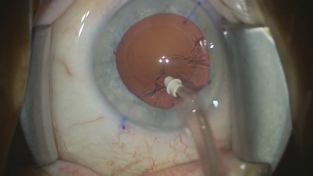 12 phaco 20220712 170802 very severe inferior post zonulae weakness ...