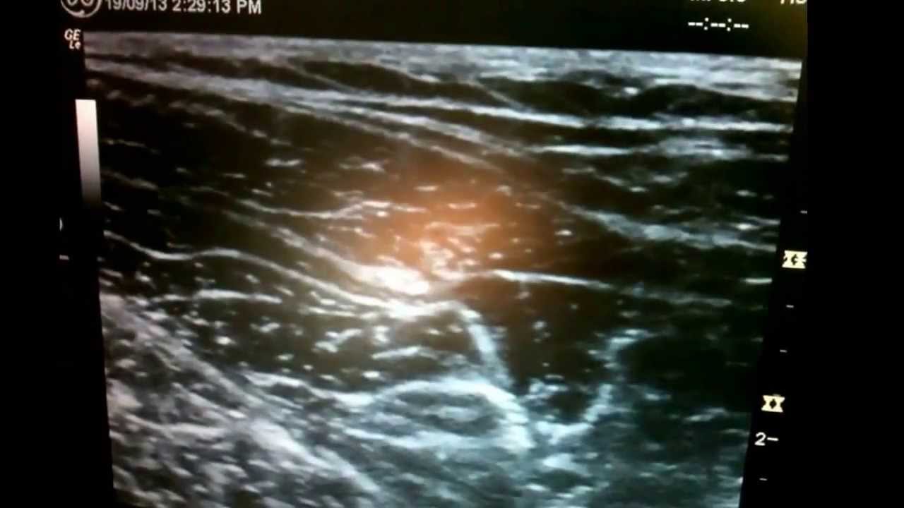 Obturator nerve block. - YouTube