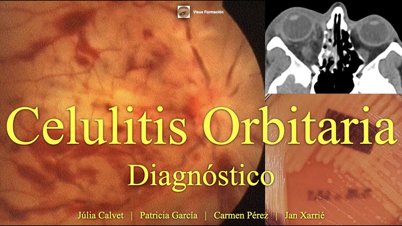 Celulitis Orbitaria. Diagnóstico. - YouTube
