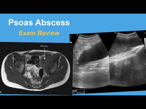 Psoas Abscess Exam Review - Lindsay Andras, MD