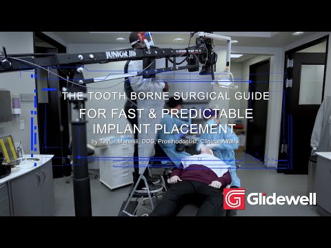 Tooth Borne Surgical Guide for Fast & Predictable Implant Placement ...