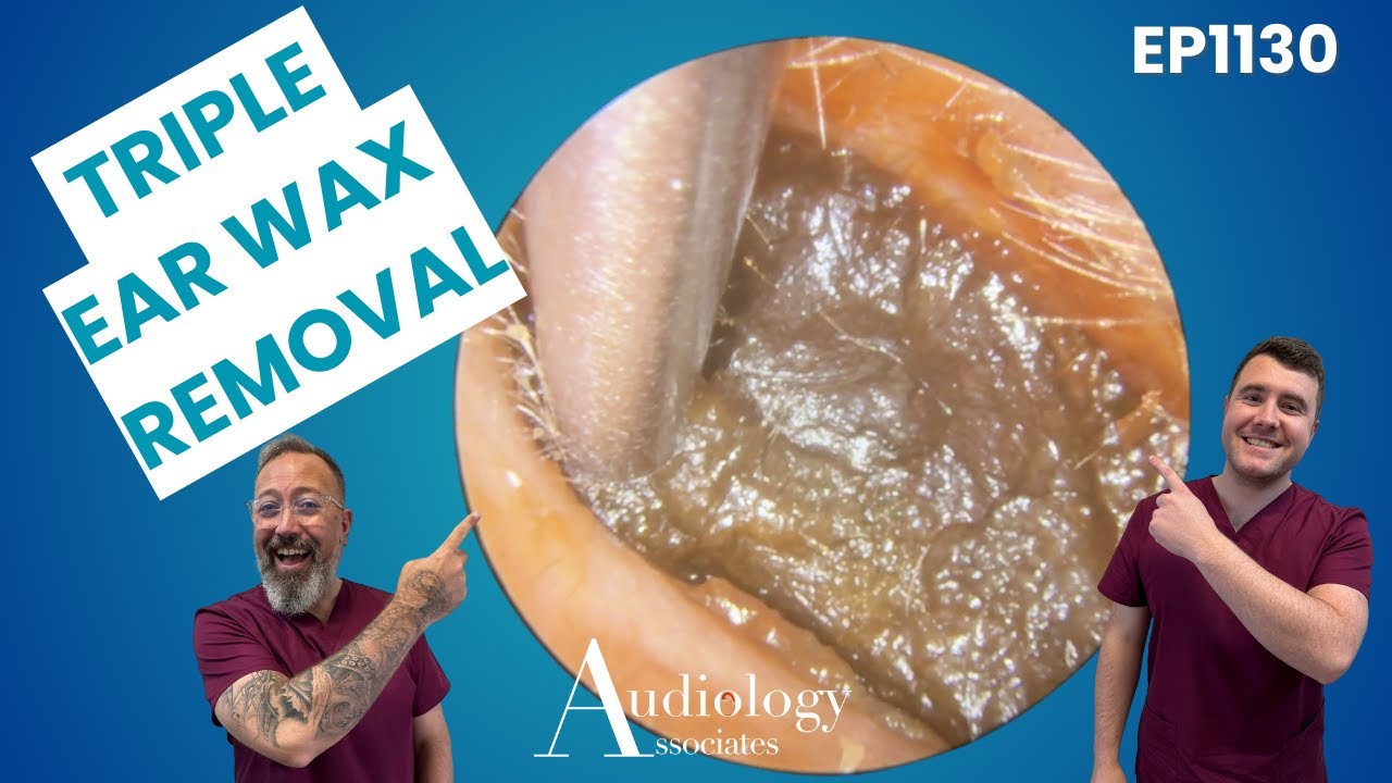 What Happens When EARWAX Buildup Gets REALLY Severe? - EP1030 - YouTube