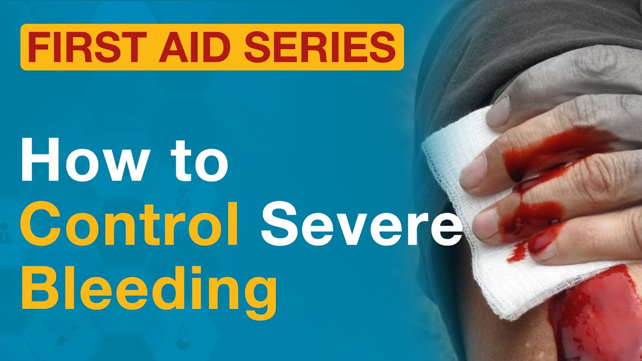 Learn to control bleeding, recognize its severity, and provide first ...