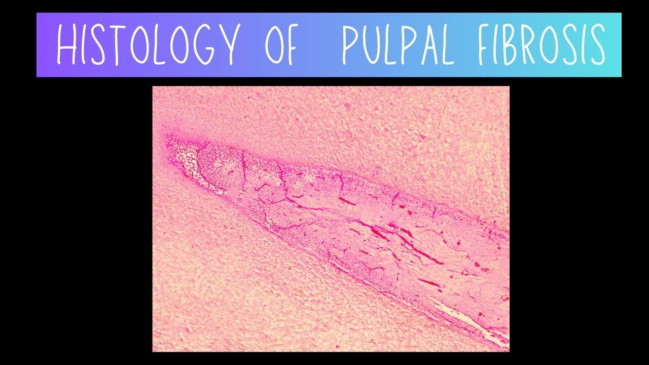 Histology of Pulpal Fibrosis - Dentistry - YouTube