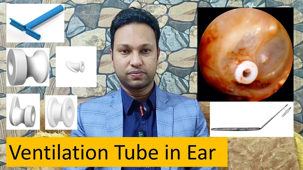 Ventilation Tube or Grommet in Ear: All You Need to Know - YouTube
