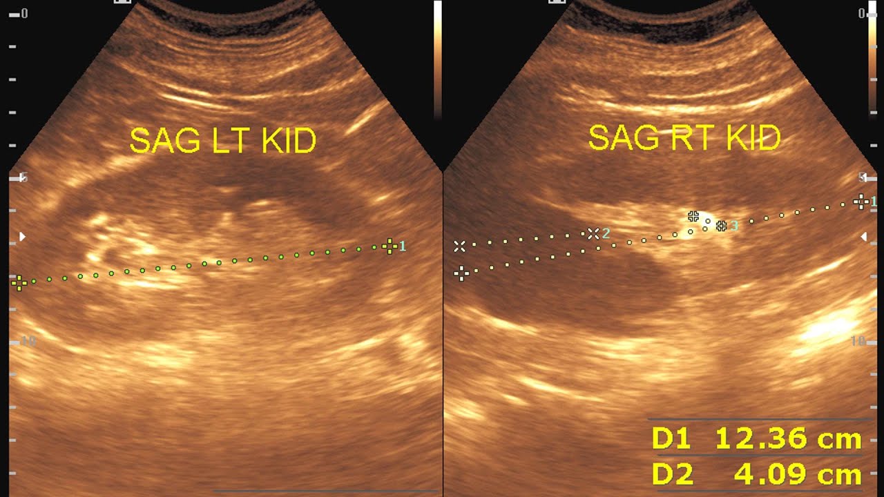 Ultrasound cases 87 of 2000 || Renal Cortical Cyst | Stone | Enlarge ...