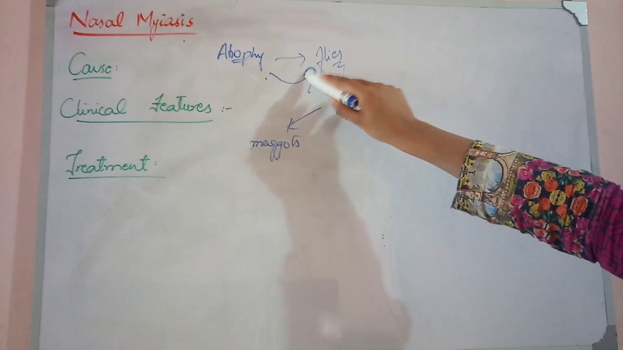 NASAL MYIASIS, maggots in nose with important stuff - YouTube