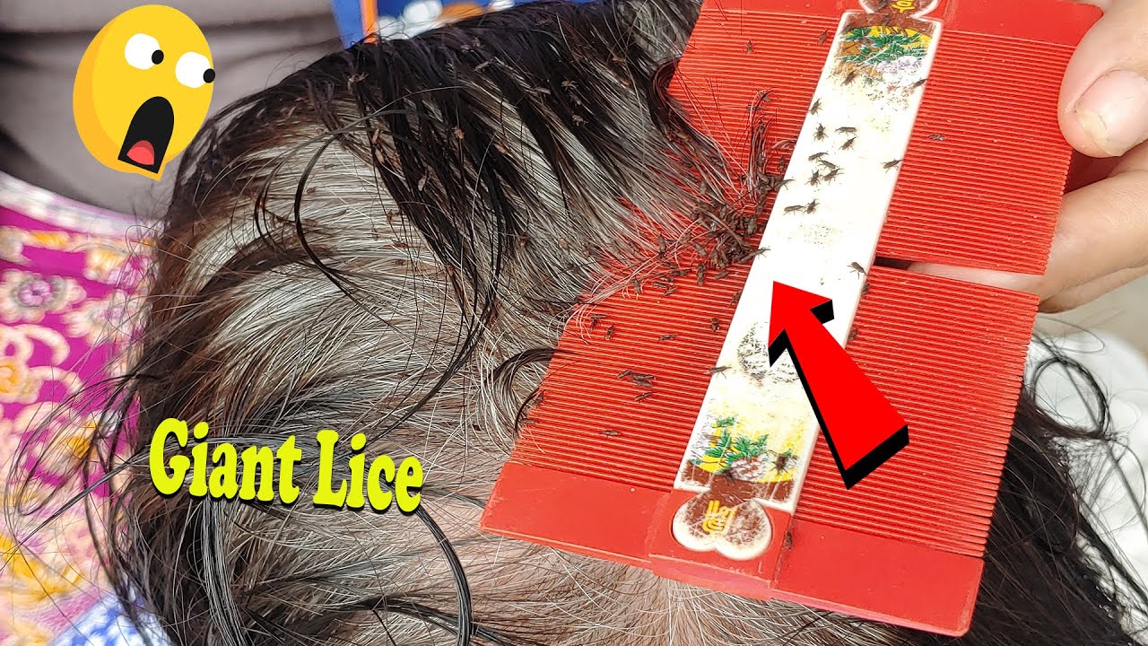 How to get ride of Hundred Giant lice from old lady - YouTube