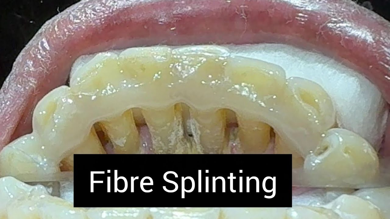 Fibre Splinting of Lower Anterior Teeth | Dental Splint - YouTube