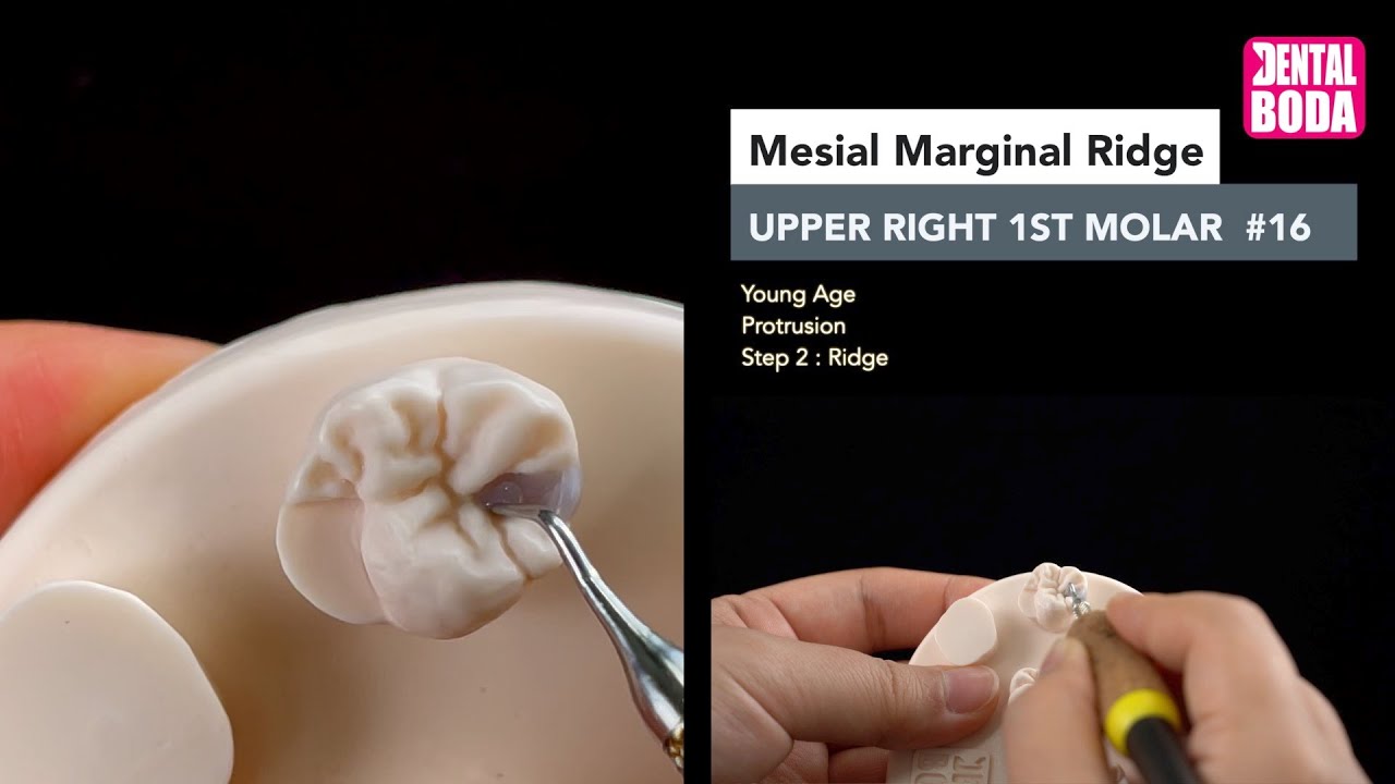 Upper Right 1st Molar mesial marginal ridge 2 ridge (young-aged) Wax-Up ...