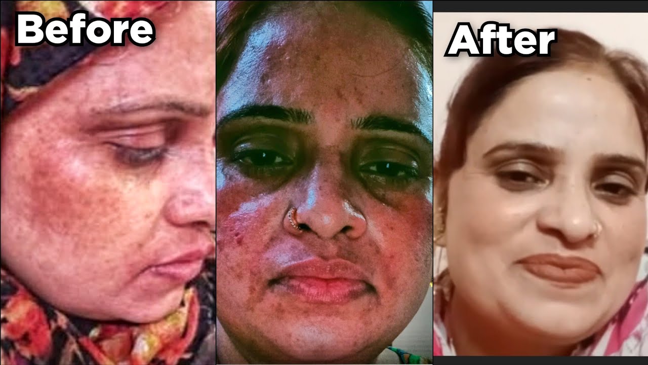 Pigmentation Khatam 100% | Bumper Remedy ka Kamal | Cooking with ...