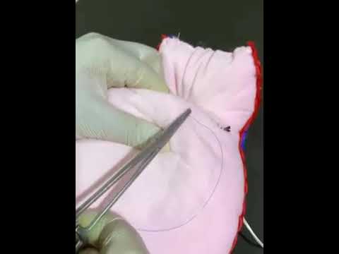 técnicas quirúrgicas Gineco SUTURA DE LYNCH - HISTERORRAFIA - TRIPLE ...
