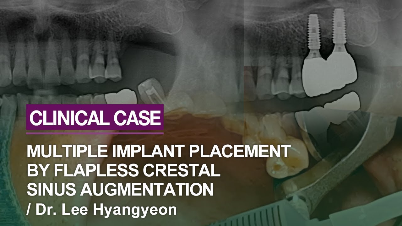 Sinus augmentation for multiple implants : flapless crestal approach ...