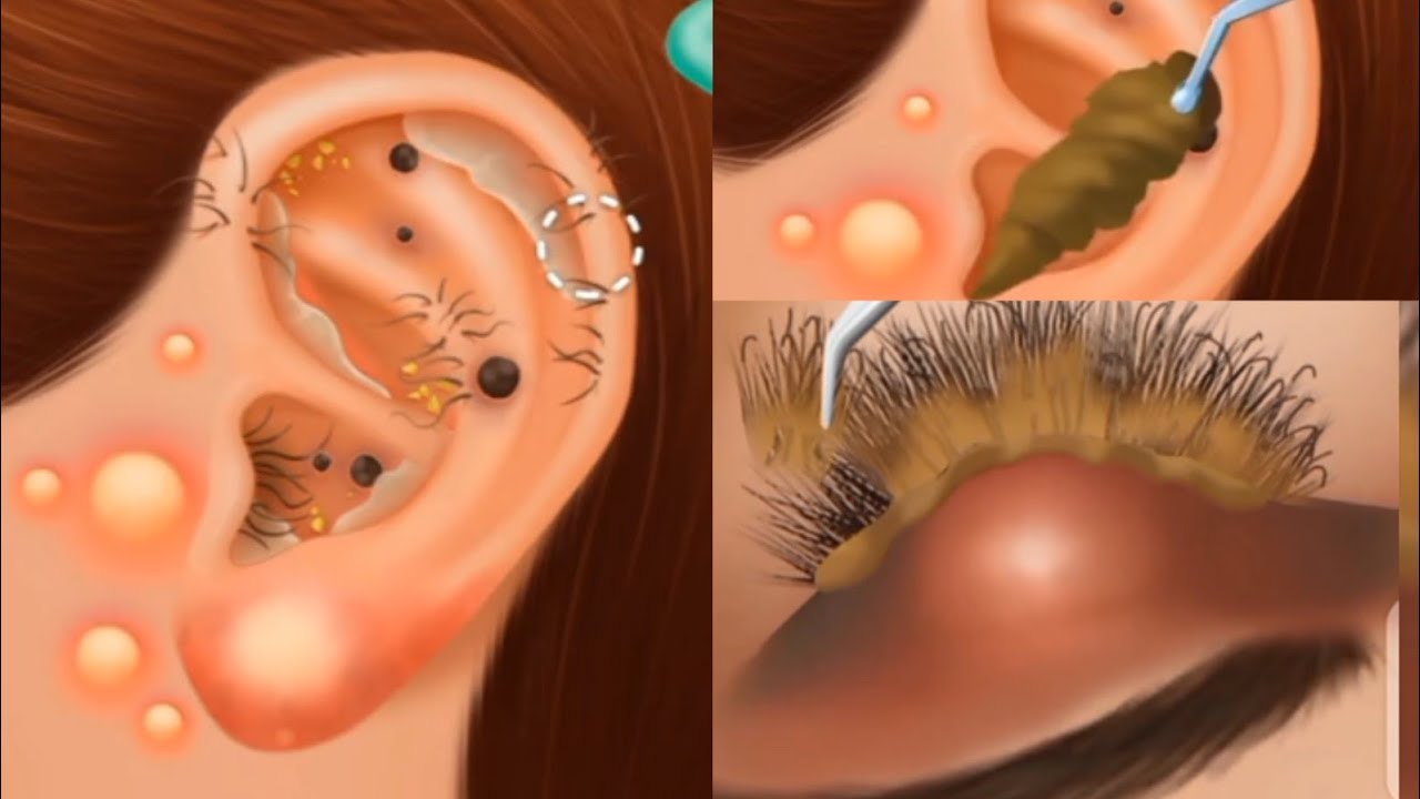 ASMR|ear pimple blackhead carelsebaceous cyst removal|Water ...