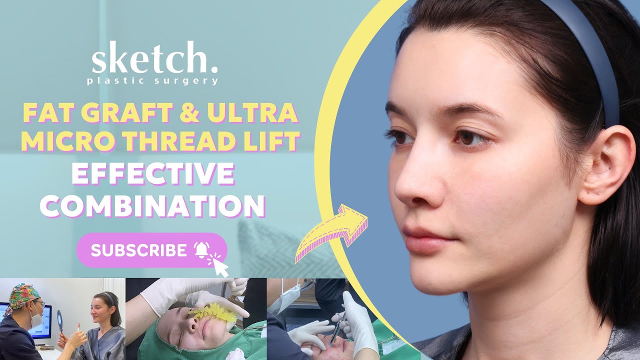 Fat Graft and Ultra-Micro Thread Lift Combination | Surgery at Sketch ...