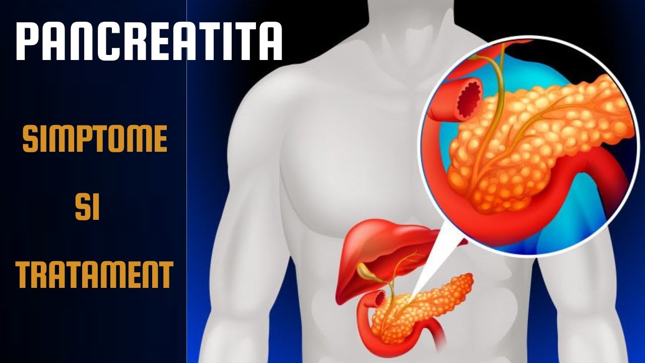PANCREATITA - SIMPTOME ȘI TRATAMENT - YouTube