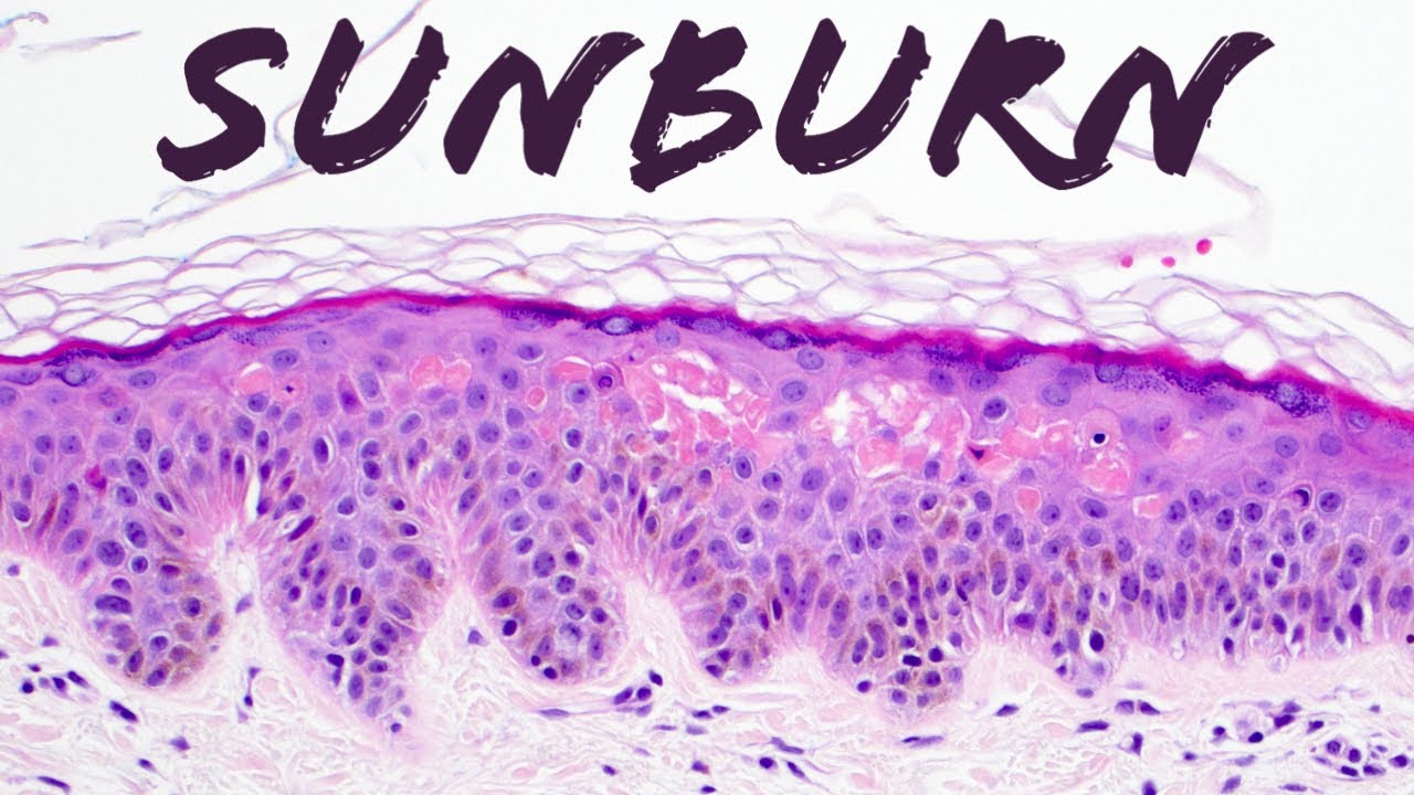 Sunburn...under the microscope (sunburn cells in a solar lentigo) - YouTube