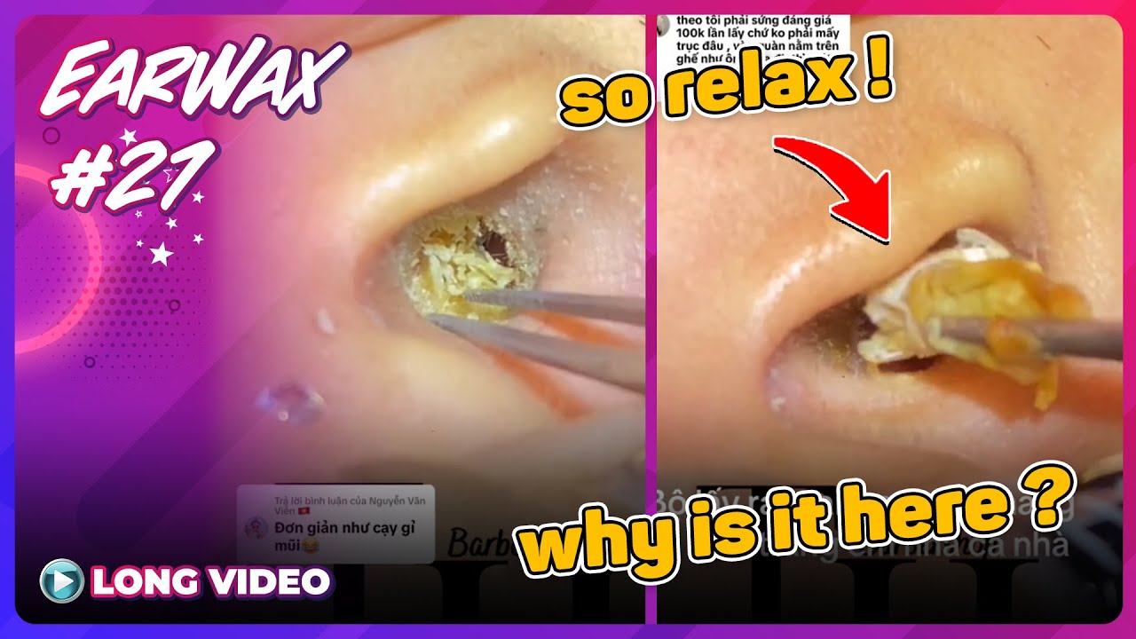 EP 27 Earwax ASMR. This is the consequence of not cleaning your ears ...