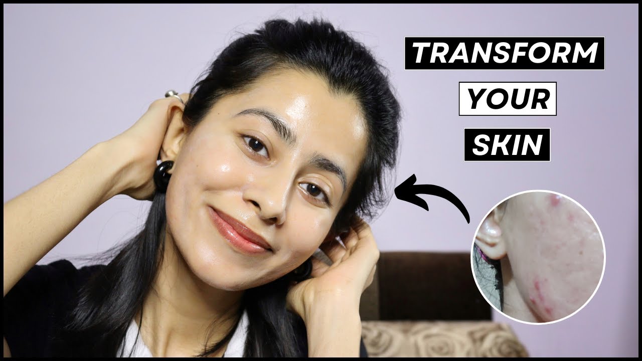 Skincare Routine For Acne - Prone Skin | How To Get Rid Of Acne, Pimple ...