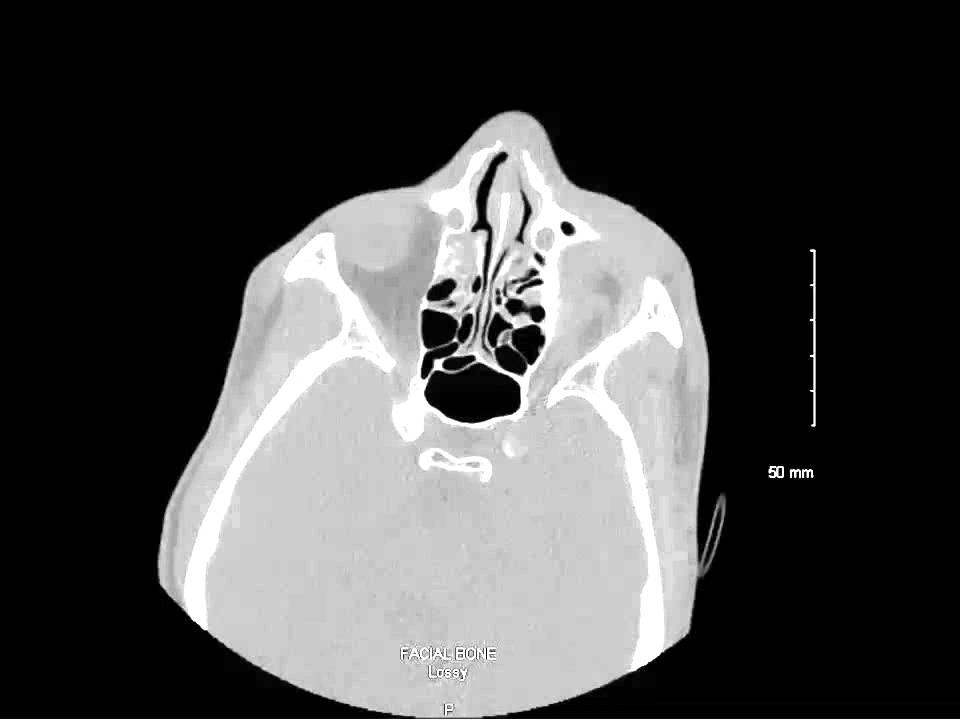CT globe rupture - YouTube
