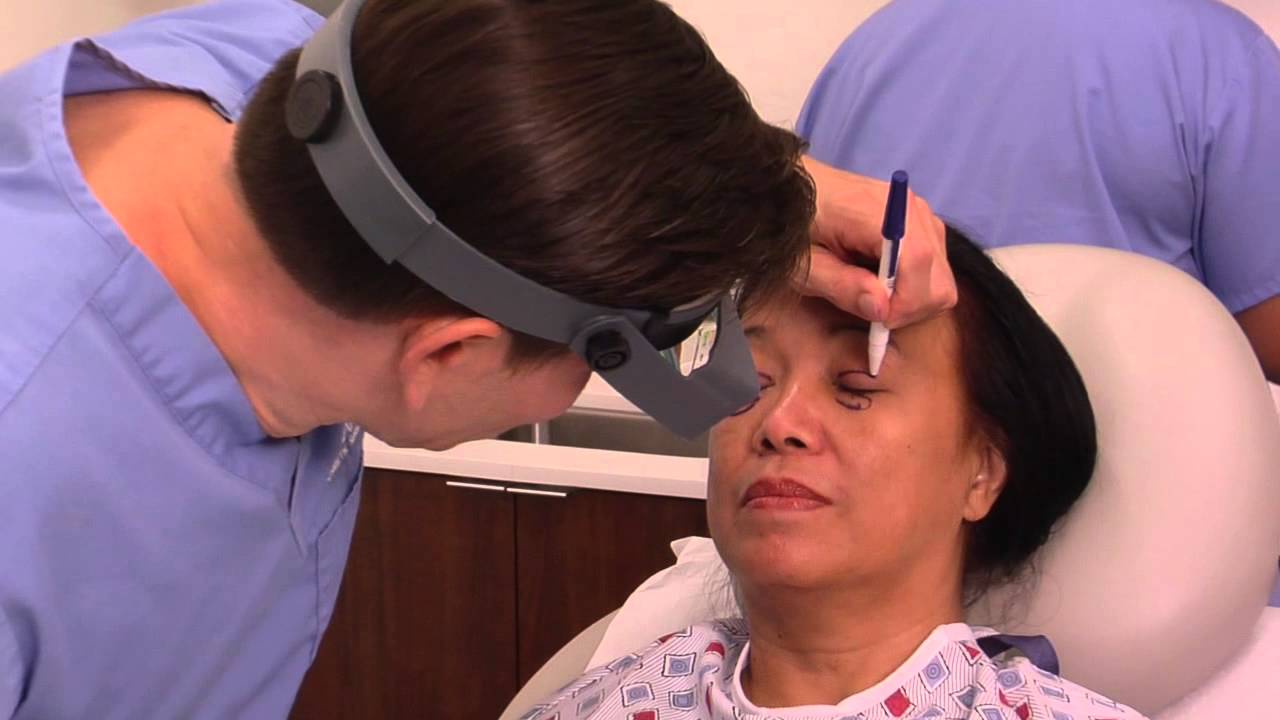 Blepharoplasty Procedure - Upper and Lower Eyelid Surgery | Palm Desert ...