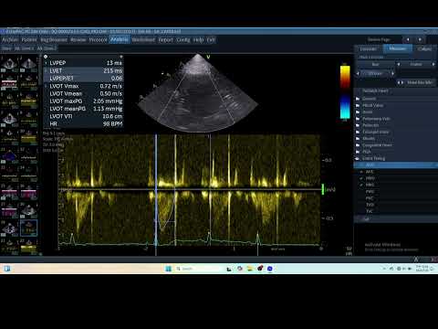 IQ 213 LVOT AV TRACE DOPPLER ECHOCARDIOGRAPHY HEMODYNAMIC MEASUREMENT ...