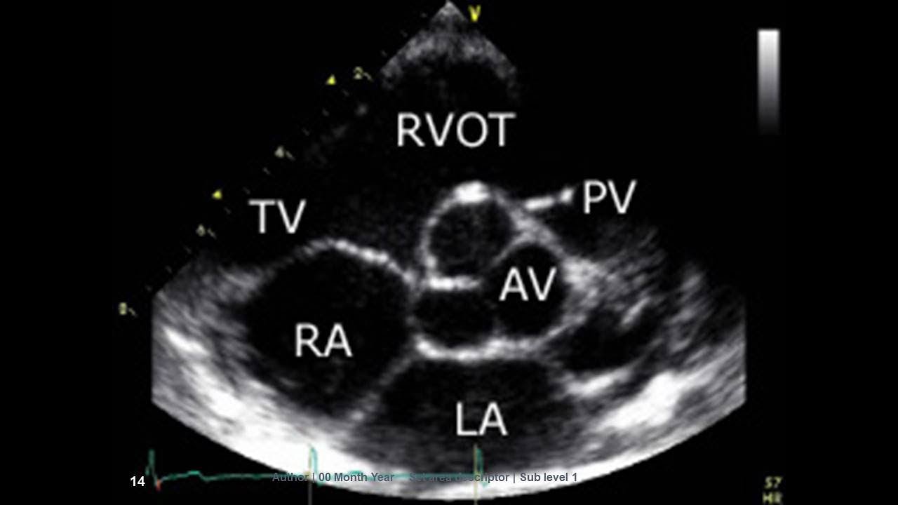 Normal echocardiography, Dr. Wael Elkilany - YouTube
