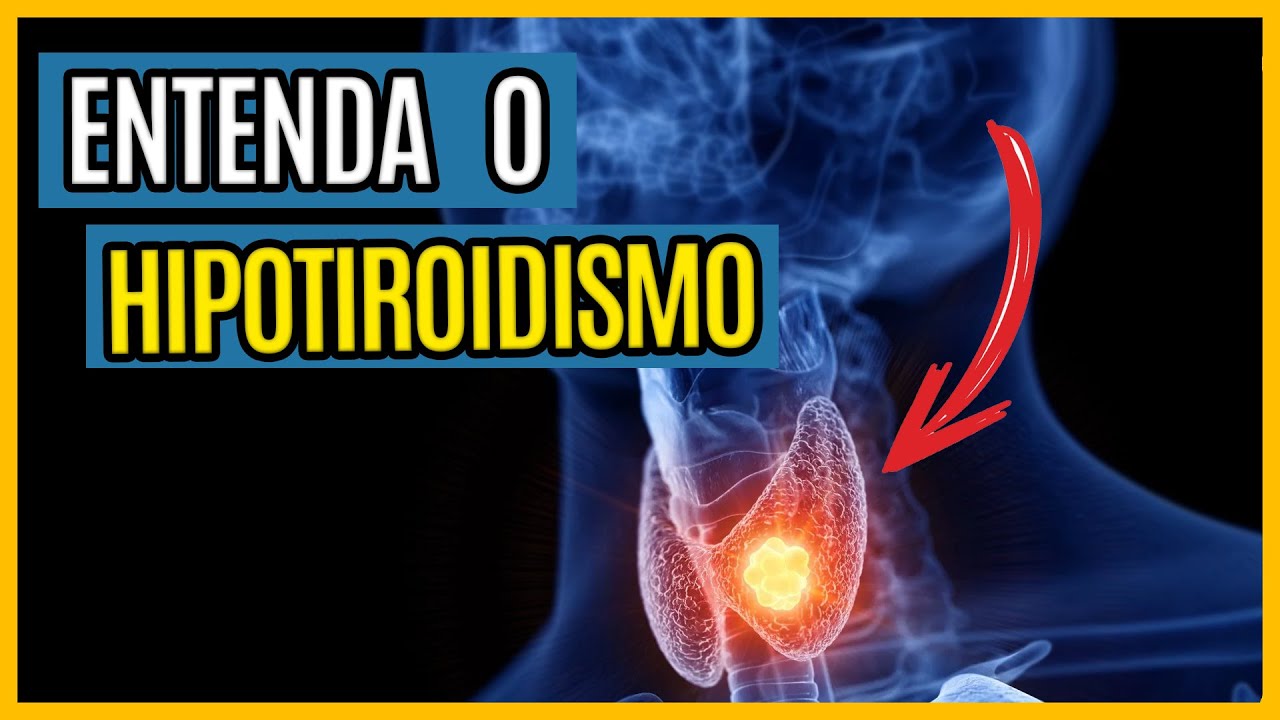 HIPOTIREOIDISMO: Principais sintomas, o que causa e o tratamento do ...