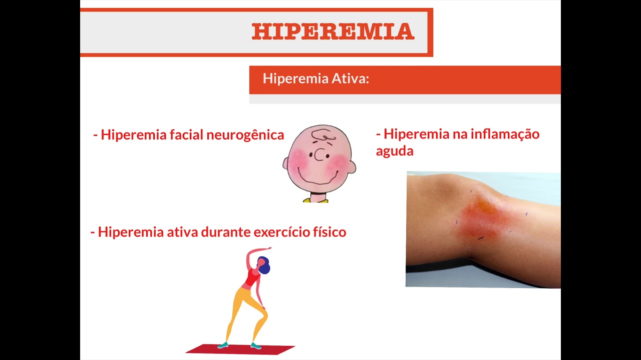 Hiperemia (Distúrbios Circulatórios PARTE I) - Patologia - YouTube