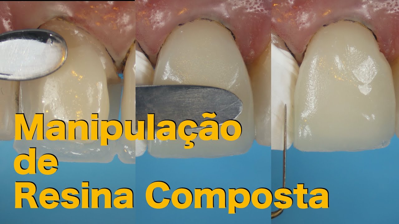 Manipulação de Resina Composta - YouTube