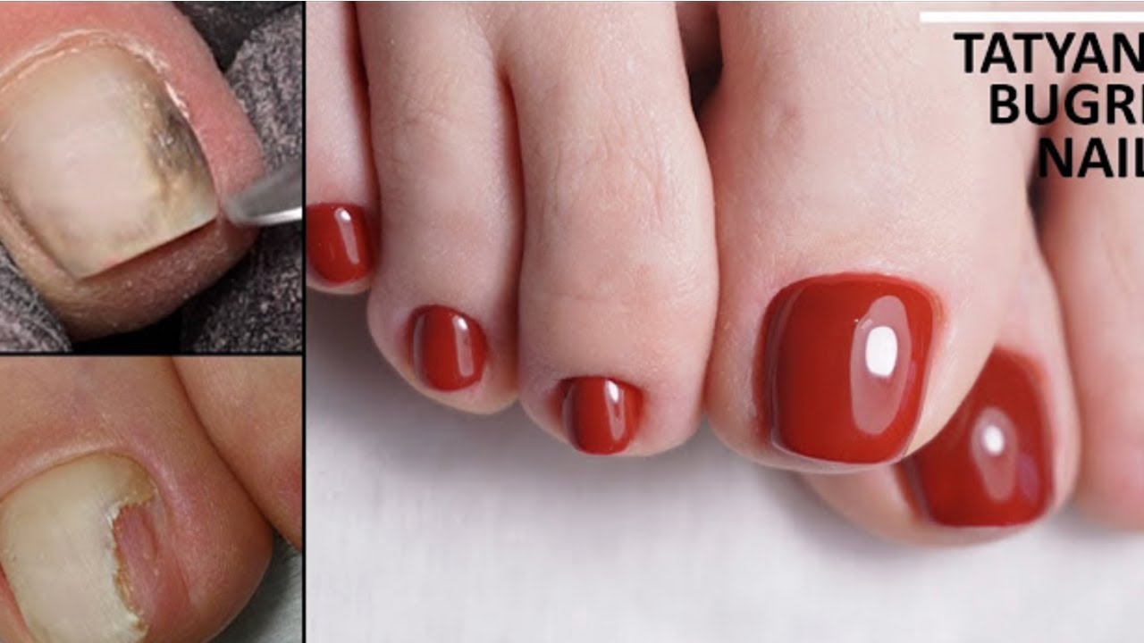 Black Toenail?! 😱 Transformation Pedicure W/ Gel - YouTube