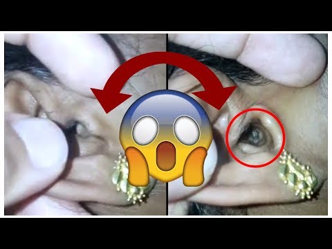 BAŞ AĞRISI ŞİKAYƏTİ İLƏ HƏKİMƏ GETDİ, QULAĞINDAN ELƏ BİR ŞEY ÇIXDI Kİ...TİBB DÜNYASI ŞOKDADIR!