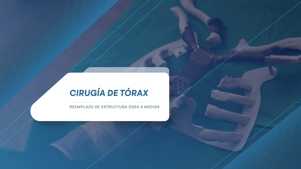 Cirugía de Tórax: Reemplazo de esternón con biomodelo - YouTube