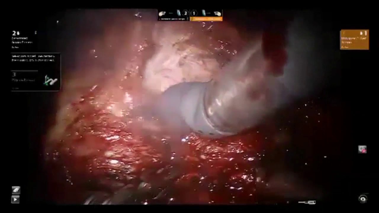 Robot Assisted Laproscopic Simple Prostatectomy |Step by Step Procedure ...